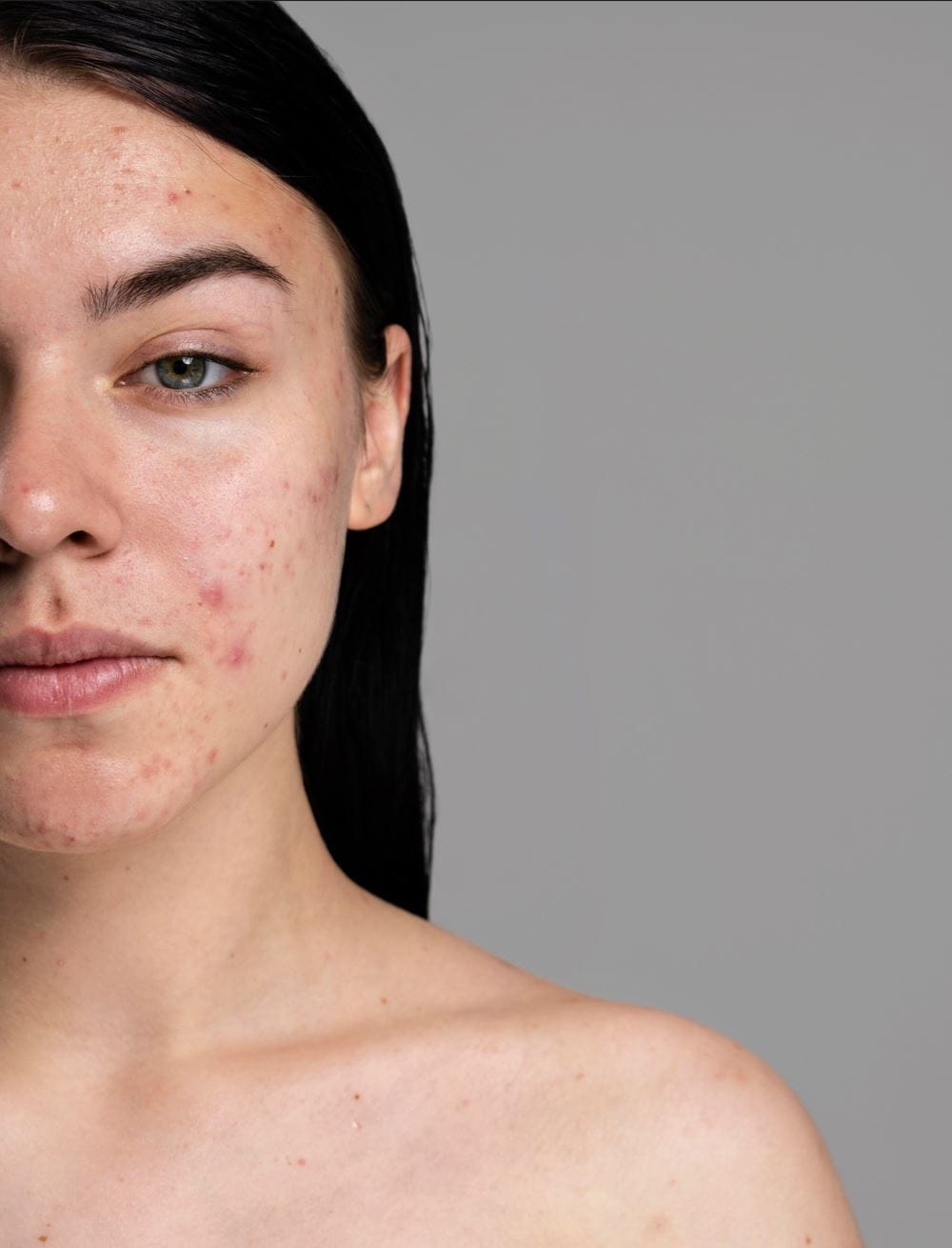 Tratament laser pentru acnee - Efectuat de medici dermatologi - Skin ...